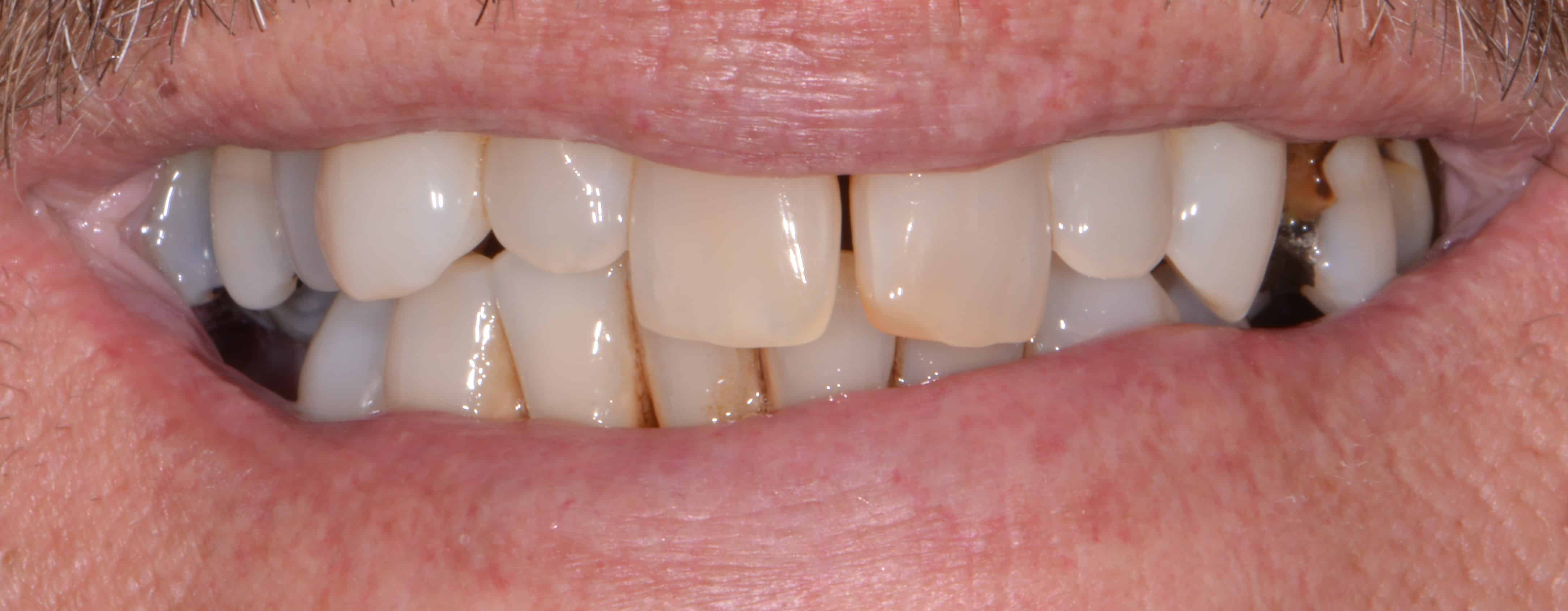 Amazing Smile Restoration | Leavitt Dentistry